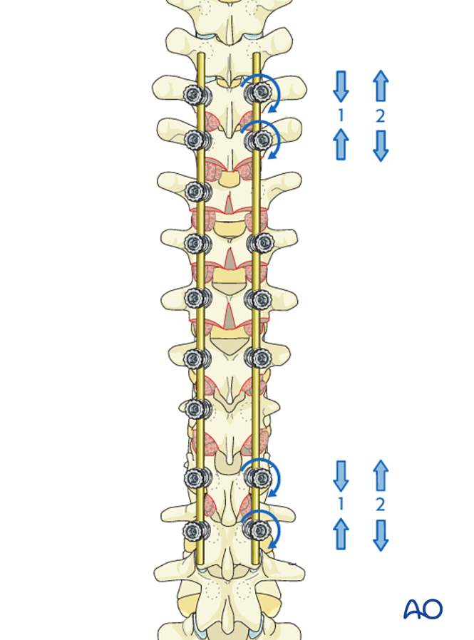 Posterior Screws - With direct vertebral body derotation for Lenke 1