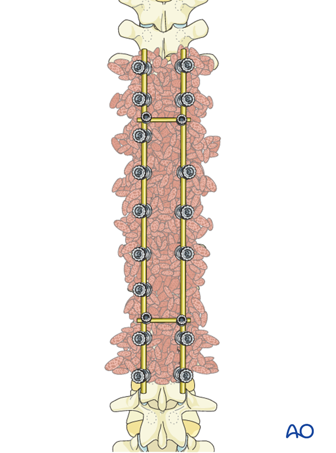 Posterior Screws - With direct vertebral body derotation for Lenke 1