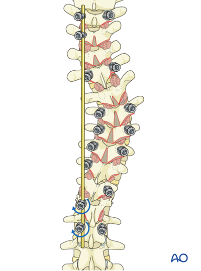 Posterior Screws - With direct vertebral body derotation for Lenke 2