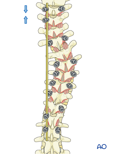 Posterior Screws - With direct vertebral body derotation for Lenke 2
