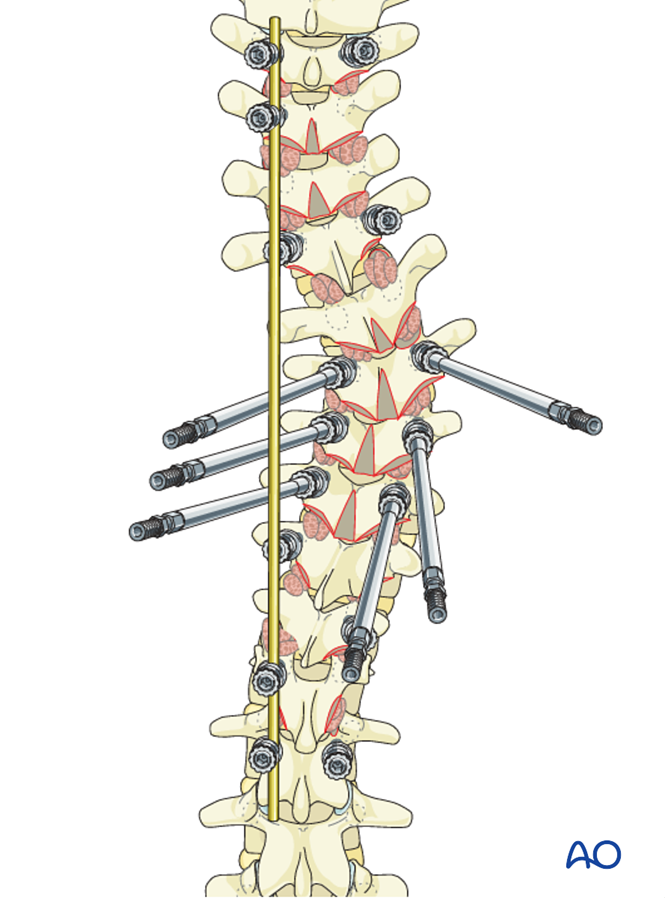Posterior Screws - With direct vertebral body derotation for Lenke 2