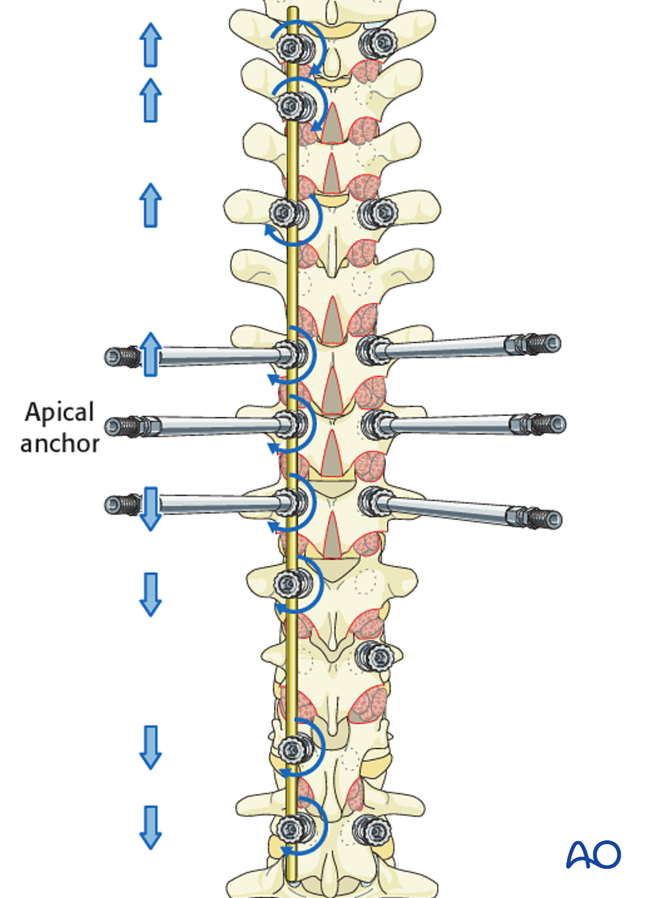 Posterior Screws - With direct vertebral body derotation for Lenke 2