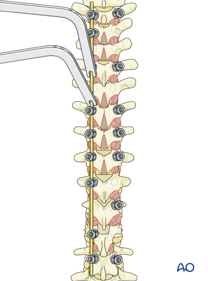 Posterior Screws - With direct vertebral body derotation for Lenke 2