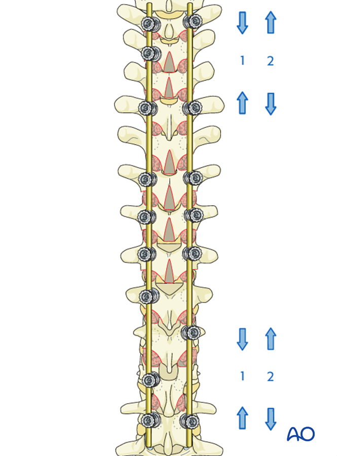 Posterior Screws - With direct vertebral body derotation for Lenke 2