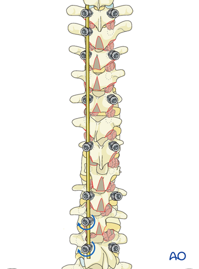 Posterior Screws - With direct vertebral body derotation for Lenke 3