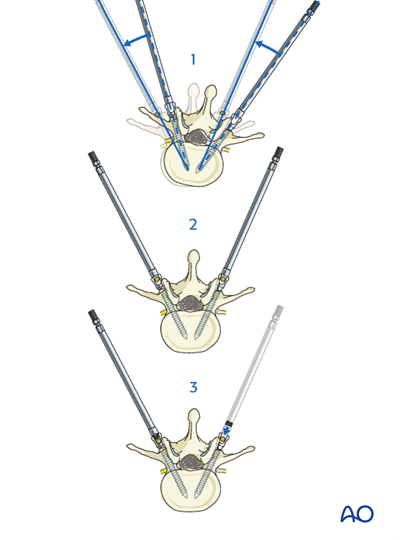 Posterior Screws - With direct vertebral body derotation for Lenke 6