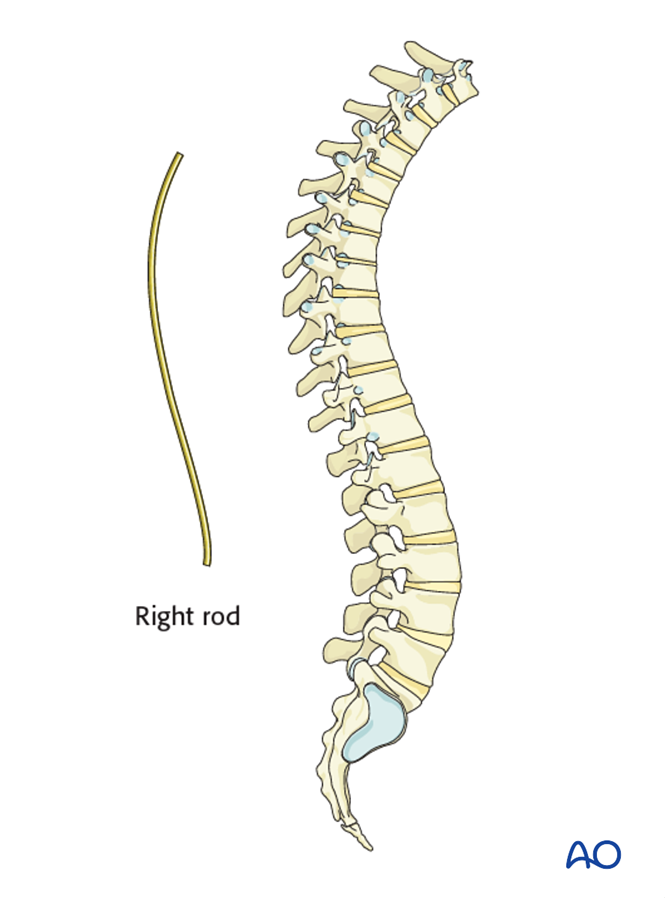Posterior Screws - With direct vertebral body derotation for Lenke 3