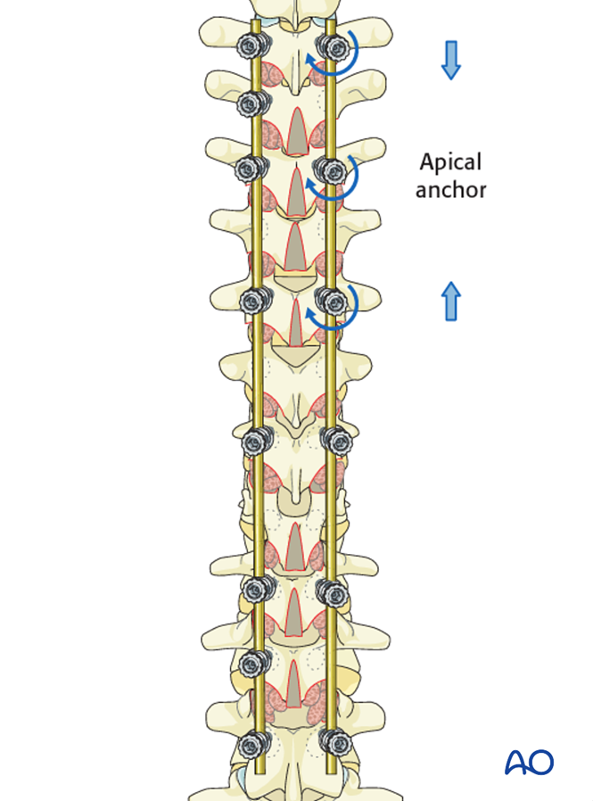 Posterior Screws - With direct vertebral body derotation for Lenke 3