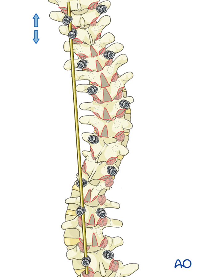 Posterior Screws - With direct vertebral body derotation for Lenke 4