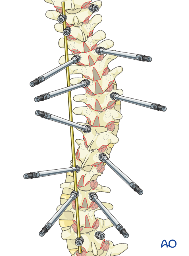 Posterior Screws - With direct vertebral body derotation for Lenke 4