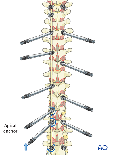 Posterior Screws - With direct vertebral body derotation for Lenke 4