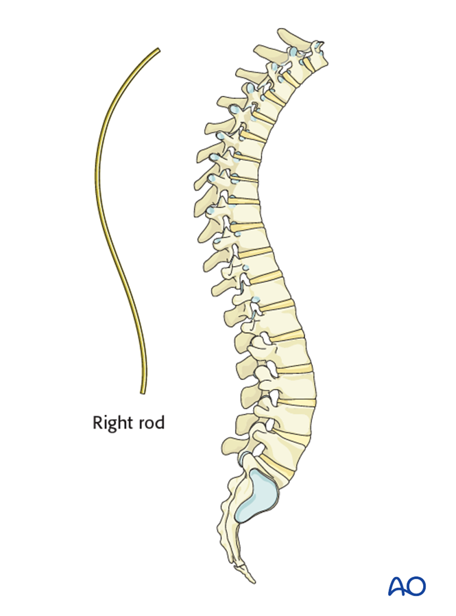 Posterior Screws - With direct vertebral body derotation for Lenke 4