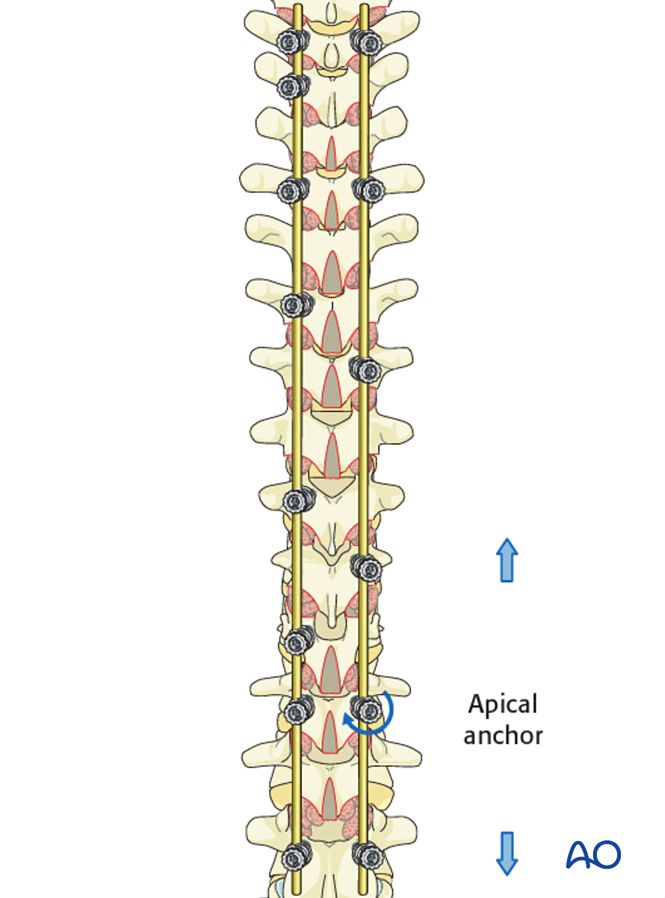 Posterior Screws - With direct vertebral body derotation for Lenke 4