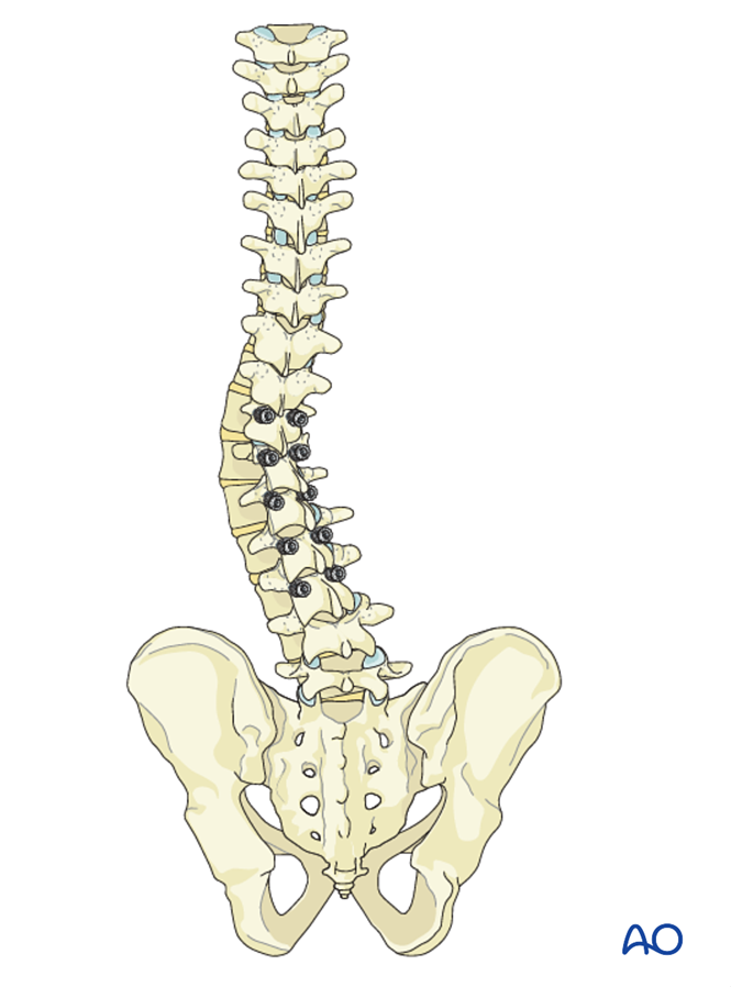 Posterior Screws - With direct vertebral body derotation for Lenke 5