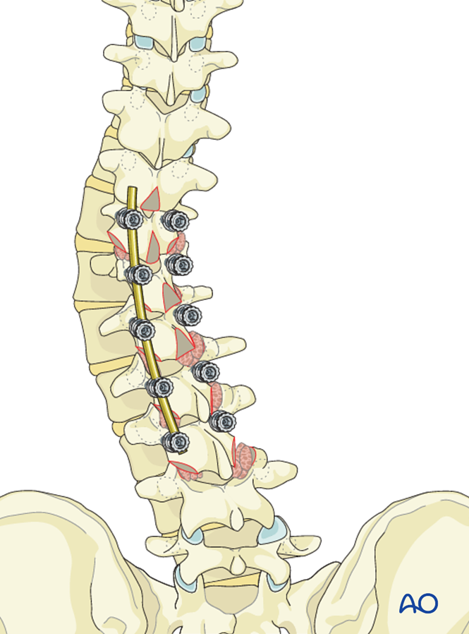 Posterior Screws - With direct vertebral body derotation for Lenke 5