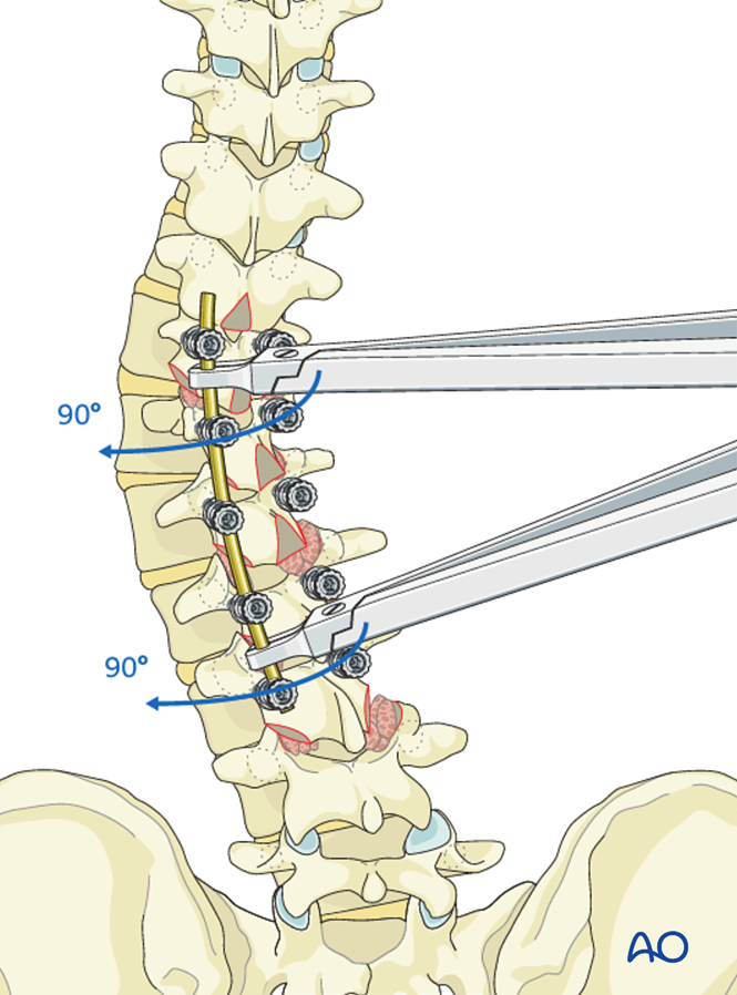 Posterior Screws - With direct vertebral body derotation for Lenke 5