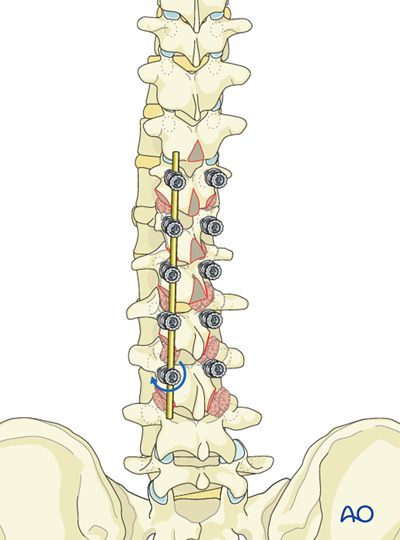 Posterior Screws - With direct vertebral body derotation for Lenke 5