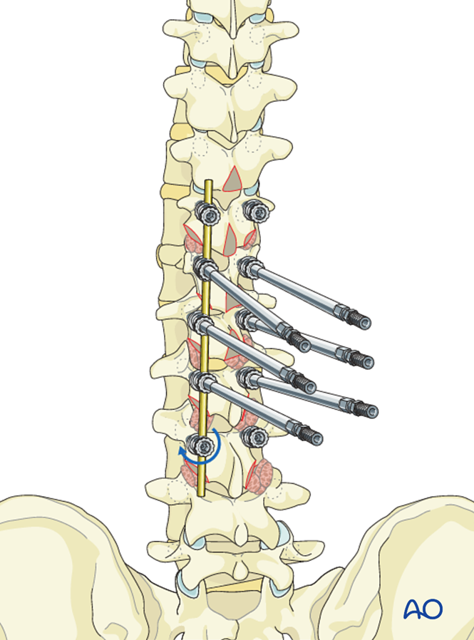 Posterior Screws - With direct vertebral body derotation for Lenke 5