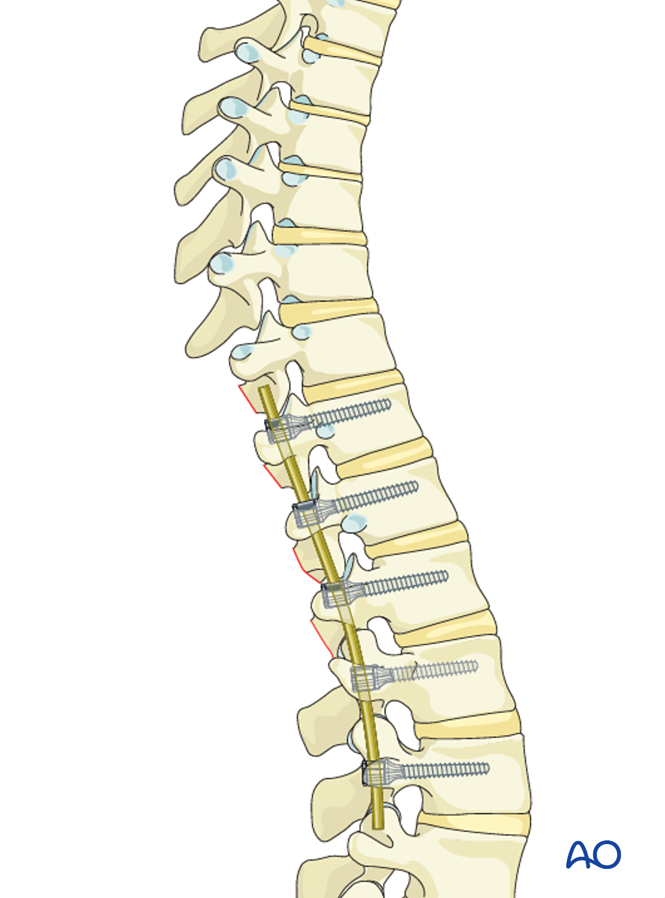 Posterior Screws - With direct vertebral body derotation for Lenke 5