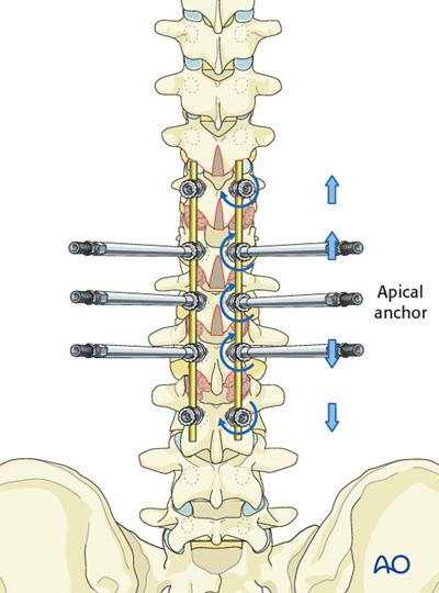 Posterior Screws - With direct vertebral body derotation for Lenke 5