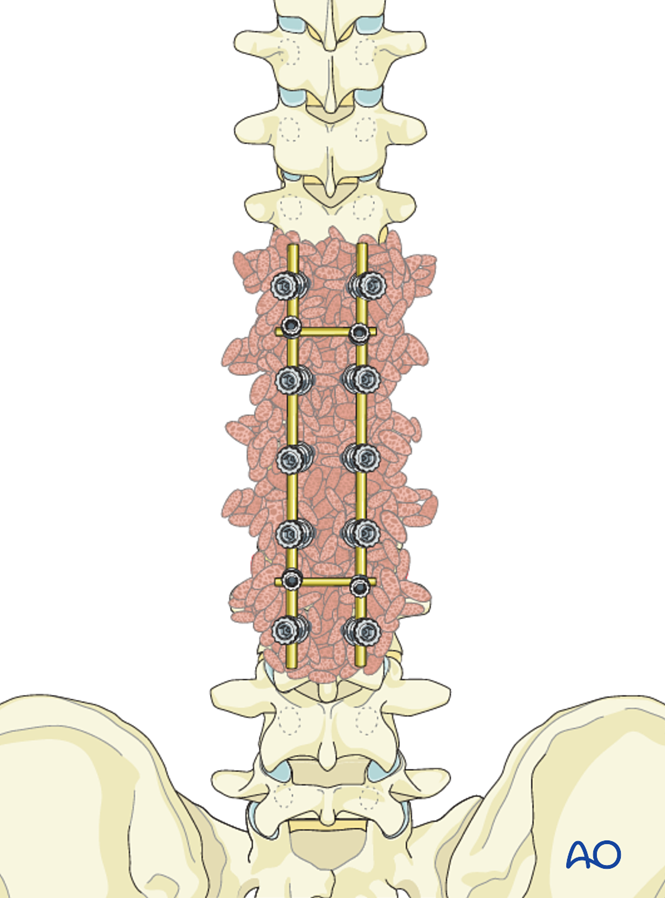 Posterior Screws - With direct vertebral body derotation for Lenke 5