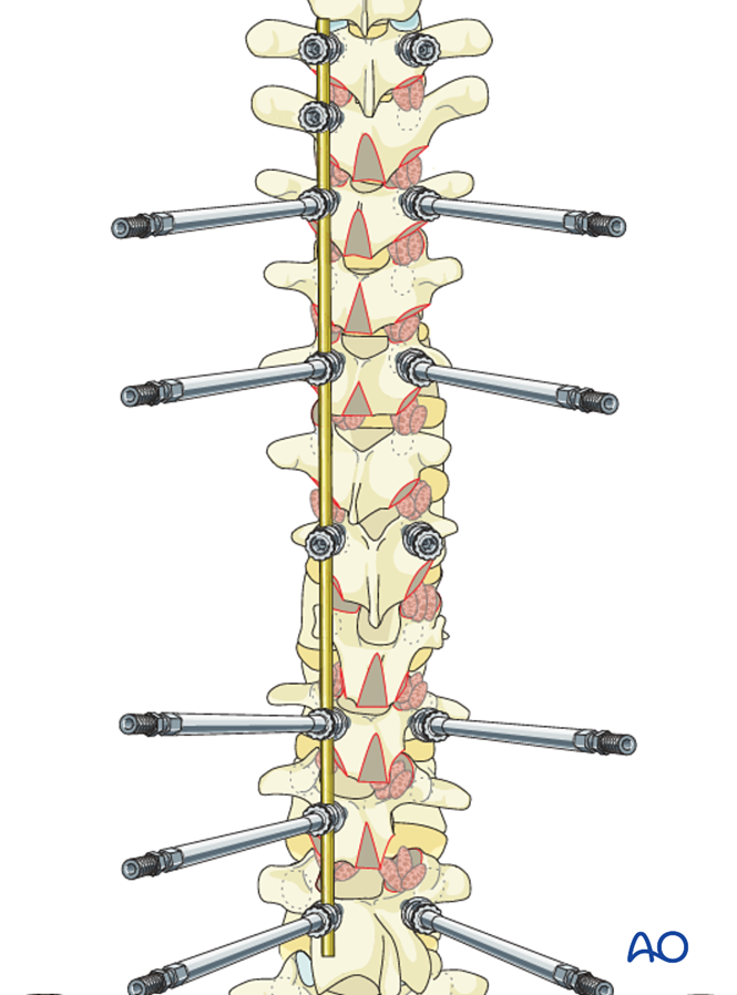Posterior Screws - With direct vertebral body derotation for Lenke 6