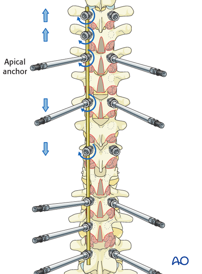Posterior Screws - With direct vertebral body derotation for Lenke 6