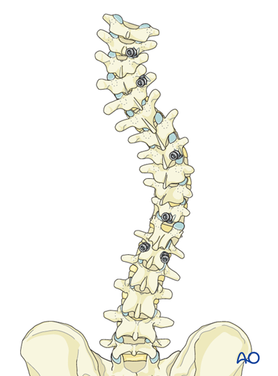 Posterior Hybrid for Lenke 2