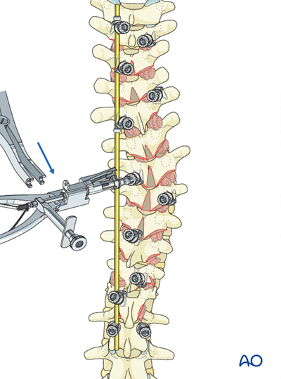 Posterior Hybrid for Lenke 2