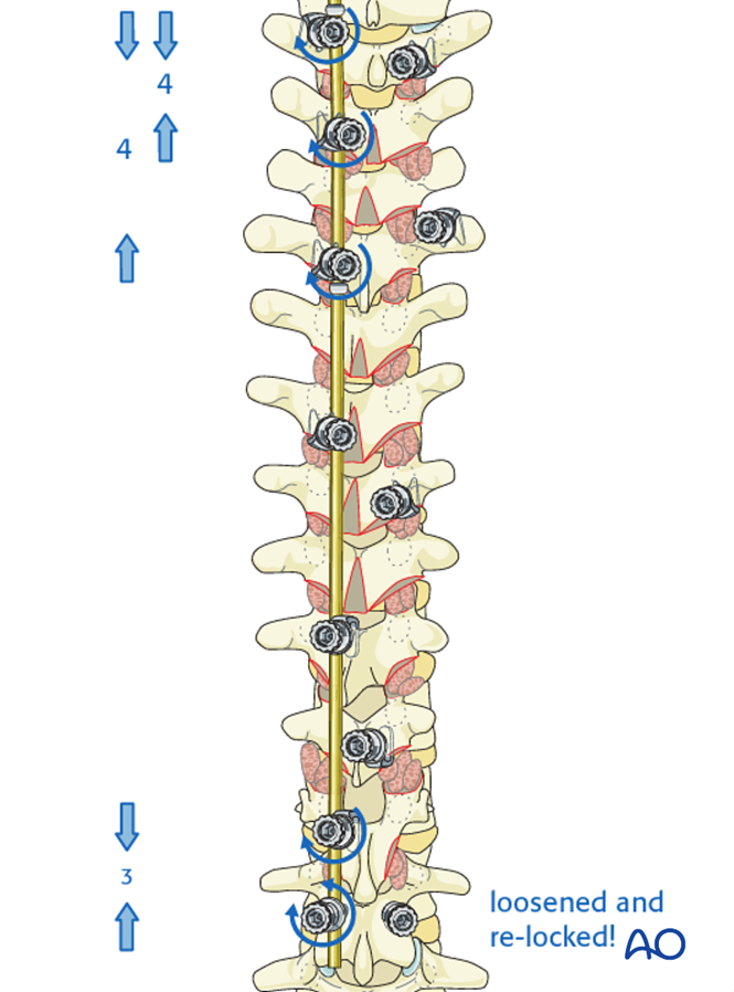 Posterior Hybrid for Lenke 2