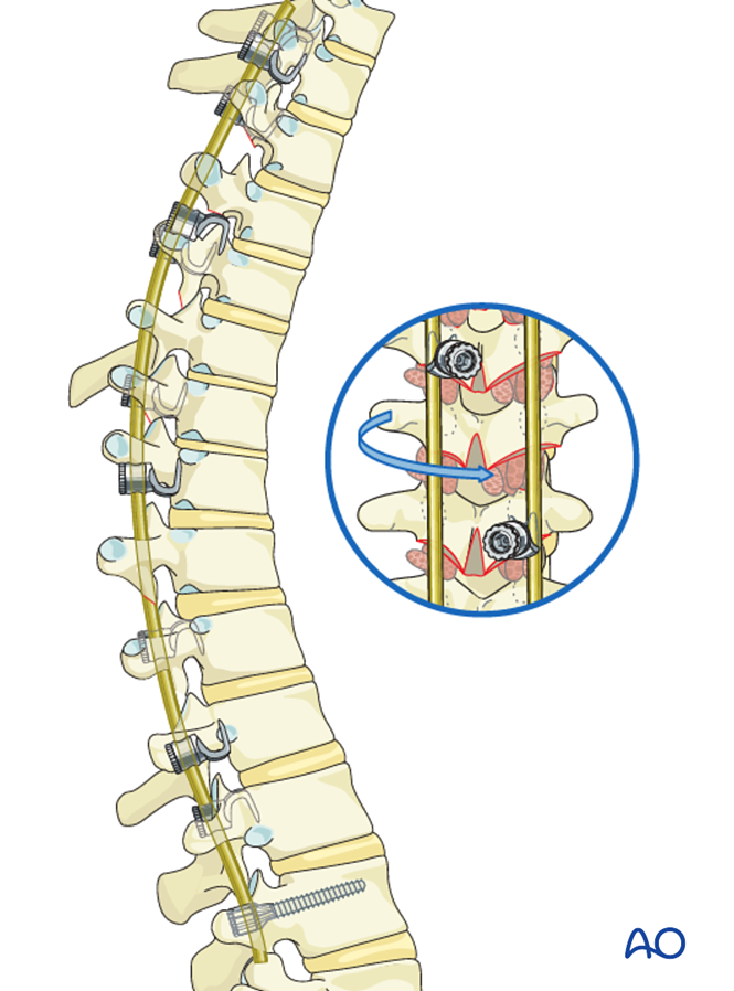 Posterior Hybrid for Lenke 2
