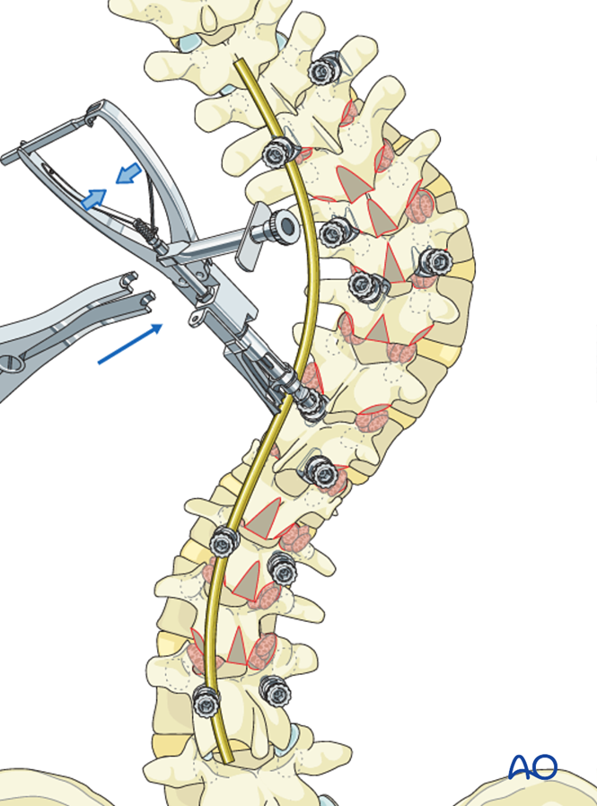 Posterior Hybrid for Lenke 3