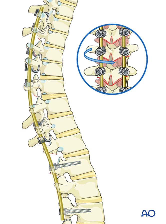 Posterior Hybrid for Lenke 3