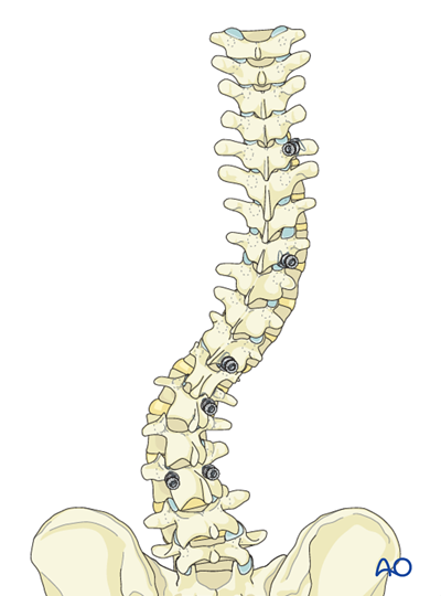 Posterior Hybrid for Lenke 6