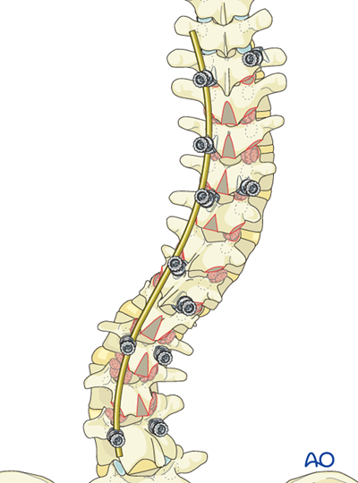 Posterior Hybrid for Lenke 6