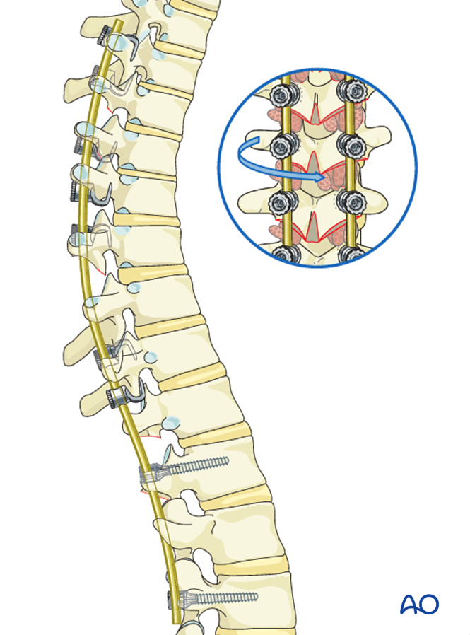 Posterior Hybrid for Lenke 6