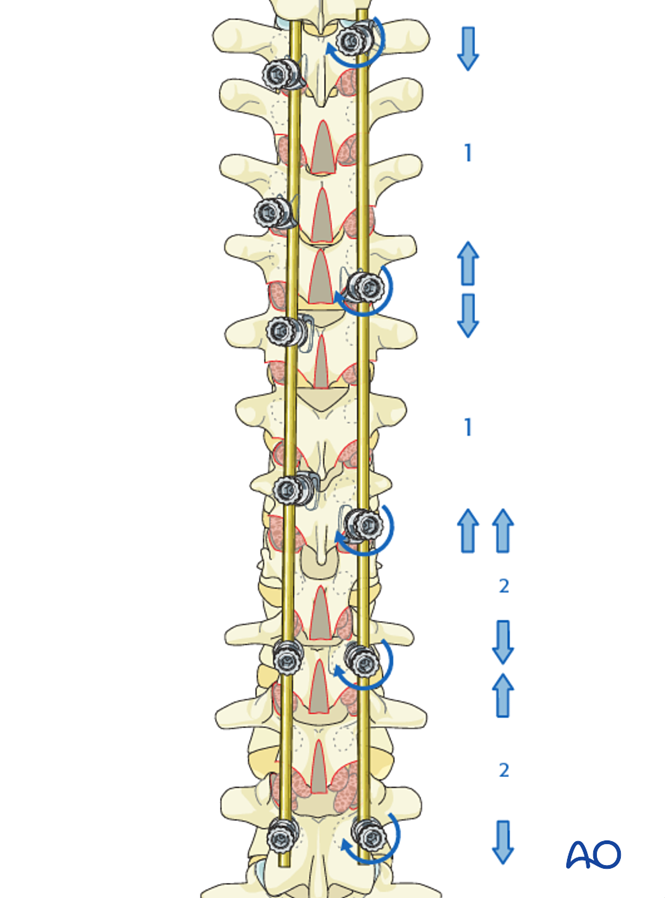 Posterior Hybrid for Lenke 6
