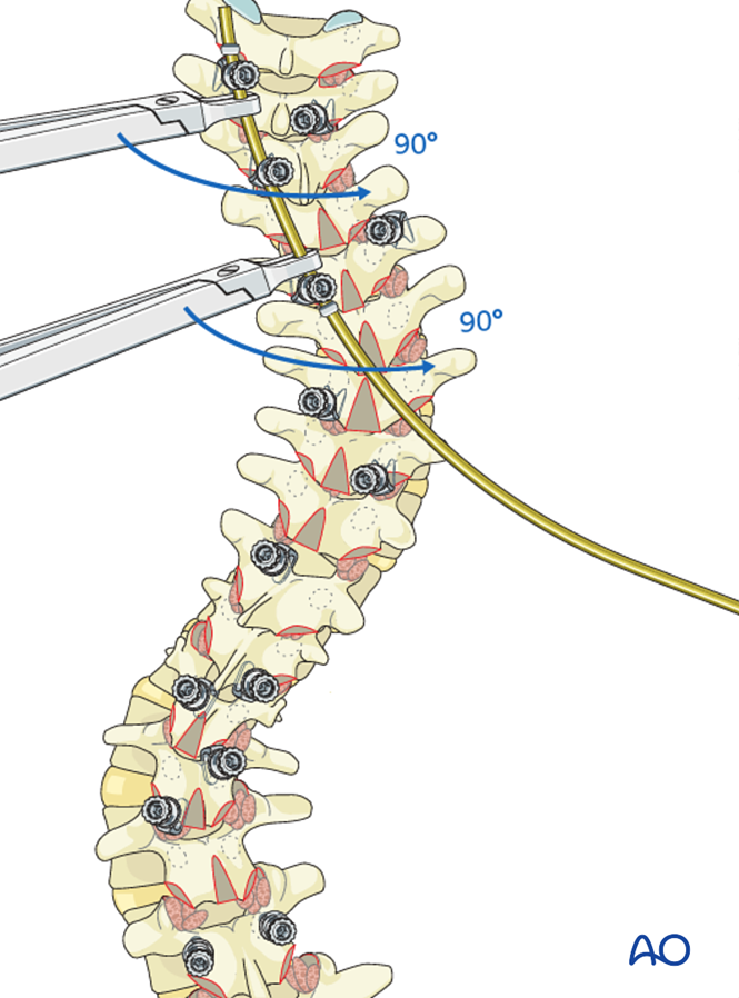 Posterior Hybrid for Lenke 4