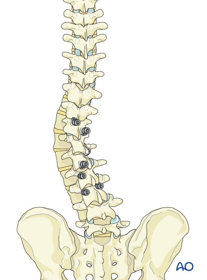 Posterior Hybrid for Lenke 5