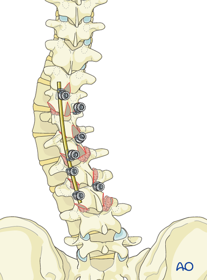 Posterior Hybrid for Lenke 5
