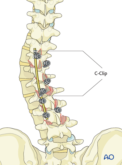 Posterior Hybrid for Lenke 5