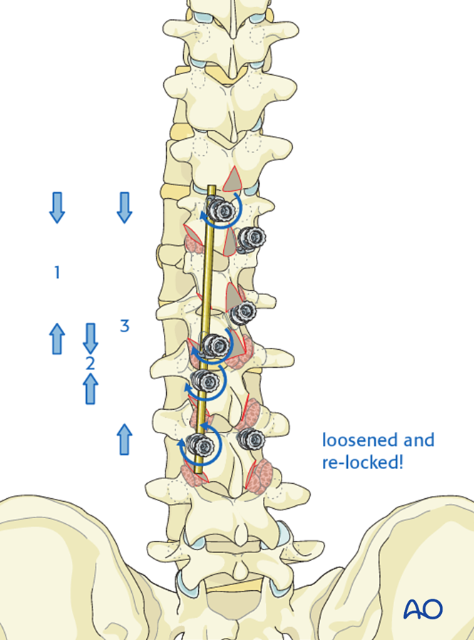 Posterior Hybrid for Lenke 5
