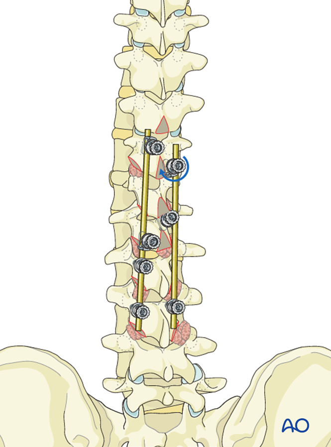 Posterior Hybrid for Lenke 5
