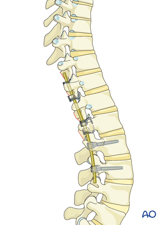 Posterior Hybrid for Lenke 5