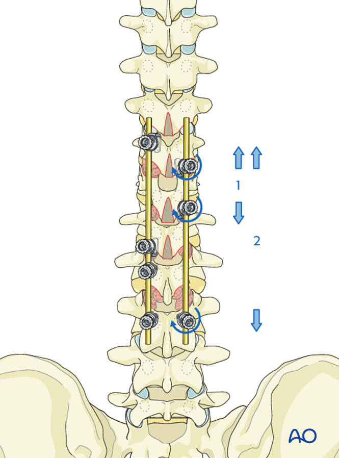 Posterior Hybrid for Lenke 5