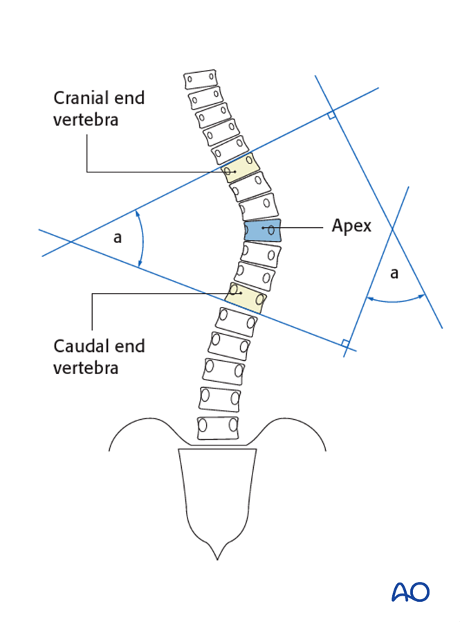 Lenke classification