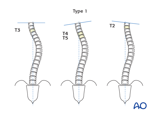 Selection of fusion level