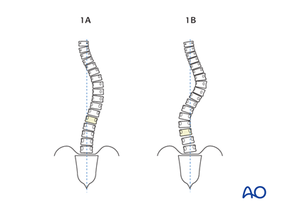 Selection of fusion level