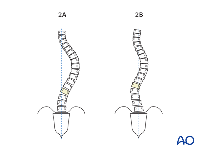 Selection of fusion level
