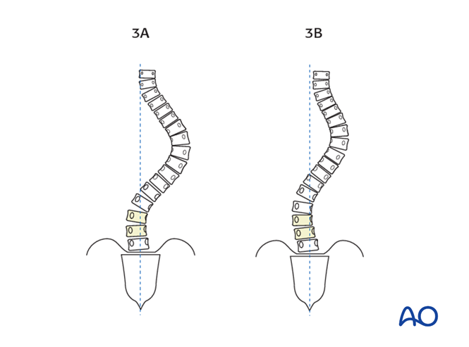 Selection of fusion level